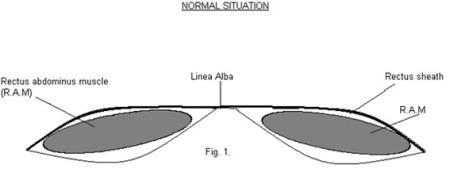 Divarication - Melbourne Hernia Clinic