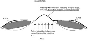 Divarication - Melbourne Hernia Clinic