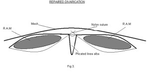 Divarication - Melbourne Hernia Clinic